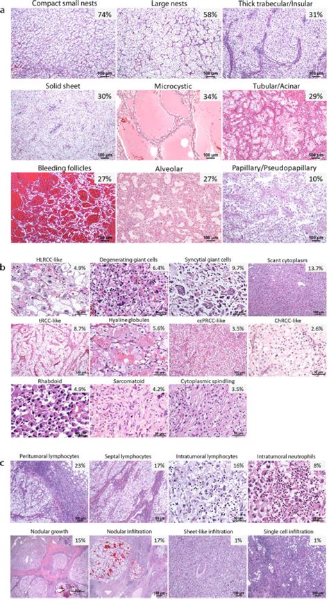 Renal Cell Carcinoma Histology