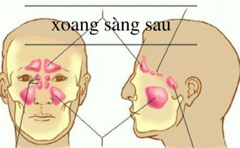 Viêm Xoang Sàng Sau Triệu Chứng Nguyên Nhân Cách Điều Trị