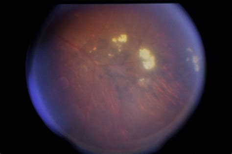 Pattern Dystrophy Retina Image Bank