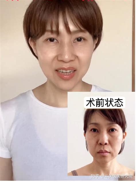 拉皮需要多少钱？国内有哪些拉皮技术好的医生，最好是在北京上海的医生 知乎