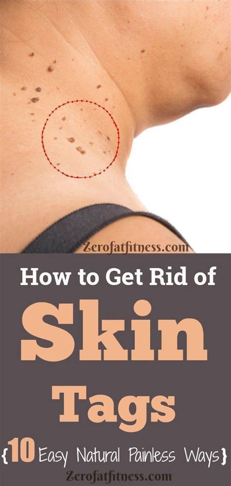 Can Duct Tape Get Rid Of Warts Artofit