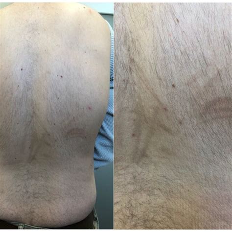 Bleomycin Induced Flagellate Dermatitis Resulting Post Inflammatory