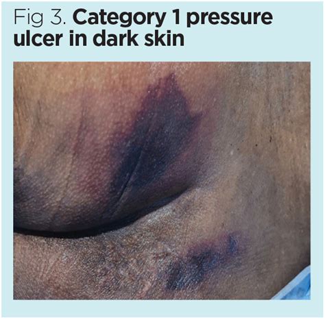 Pressure Ulcer Education 3 Skin Assessment And Care Nursing Times