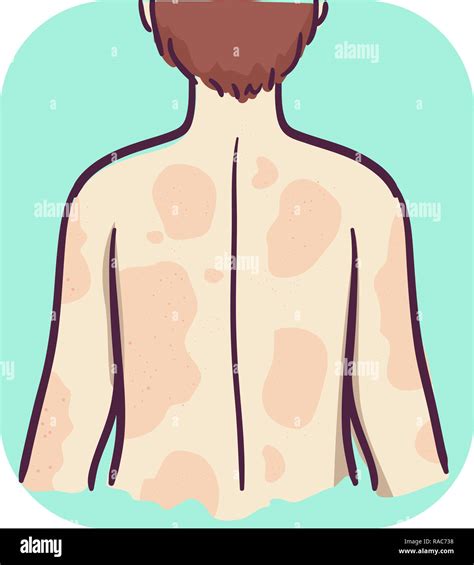 Illustration Of A Man Showing His Back And Breaking Out In Hives Stock