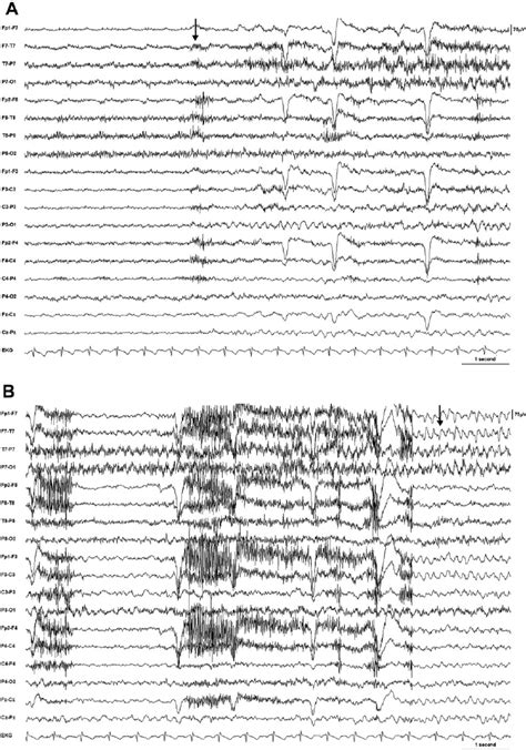 Consecutive 10 Second Epochs Of A Left Temporal Seizure On An Download Scientific Diagram