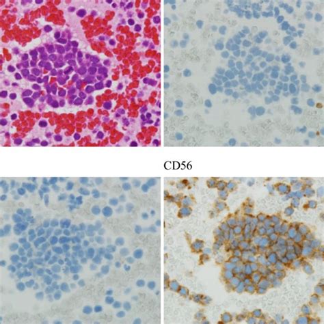 Pdf Bone Marrow Metastasis Of Rhabdomyosarcoma Mimicking Acute