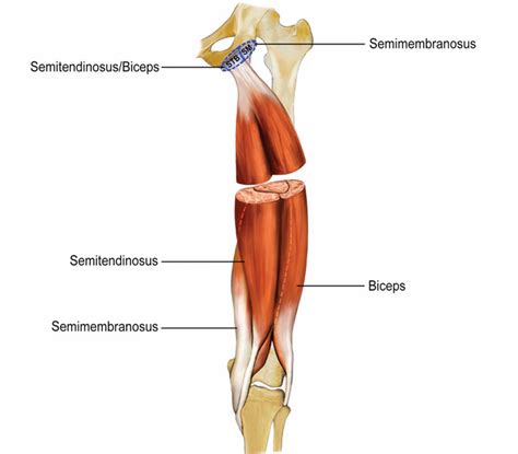 Ischial Apophysis Avulsion Fracture Sports Medicine Review