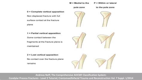 Condylar Fracture Pptx