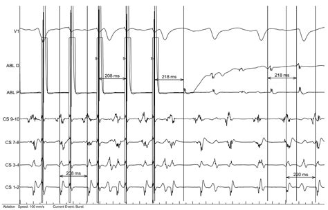 Spatial Relationship Of Sites For Atrial Fibrillation Drivers And Atrial Tachycardia In Patients