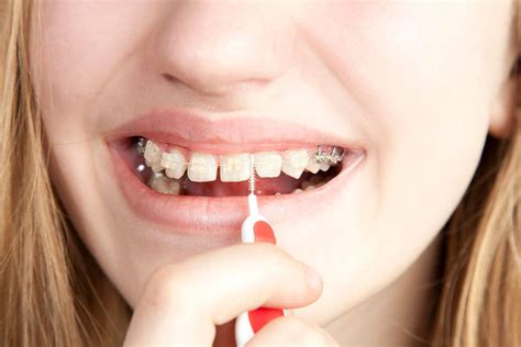 Brackets De Zafiro Ventajas Y Desventajas Precios BUCAL ORG