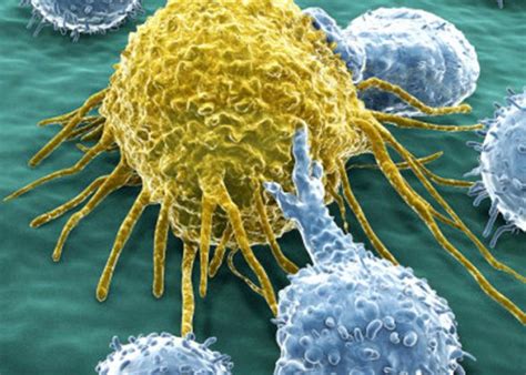 Estas Son Las Diferencia Entre Un Tumor Y El C Ncer Tn Tv