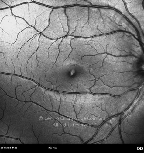 Caso Clínico 1 Atlas RL Eye
