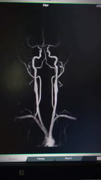 Abu Bakar Siddiq Shaik On Linkedin 4d Scan Of Intra And Extra Cranial