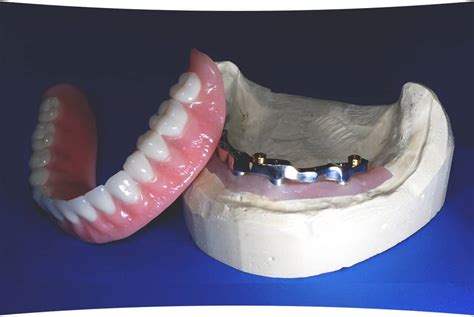 What Is A Bar Attachment Denture At Timothy Clifton Blog