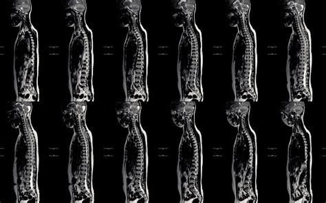 Mrtwirbelsäule Zeigt Masse An Distaler Schnur Und Conus Medullaris Mit
