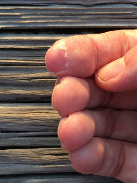 Frostbite Finger