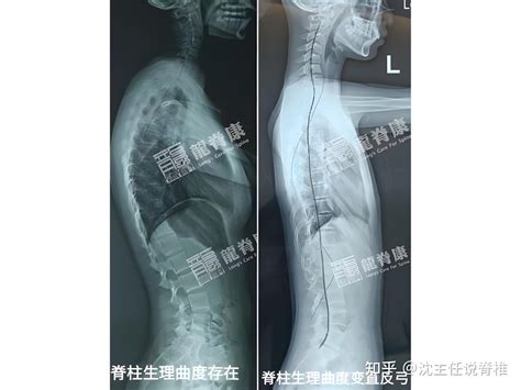 生理曲度变直反弓是怎么回事可以做哪些锻炼 知乎