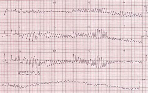 When The Storm Strikes Hard Incessant Vtvf Complicated By Cardiogenic