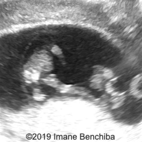 📃 Twin Reversed Arteriap Perfusion Sequence