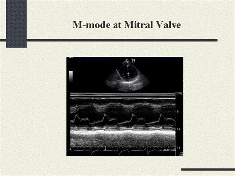 Mmode Echocardiogrphy The Lost Art Mmode Physics B