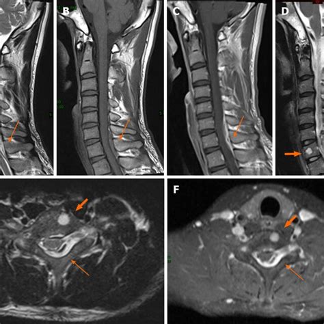Preoperative Magnetic Resonance Imaging A And D Sagittal T2 Weighted