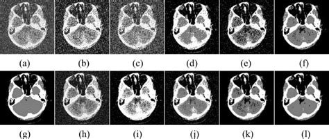 the segmentation results of different algorithms on medical image ct22