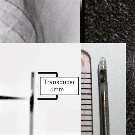 Criteria For Cl Tbb The Distance From The Rp Ebus Probe Tip To The
