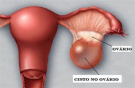 Veja os Principais Sintomas e Causas do Cisto no Ovário Dicas do Dia
