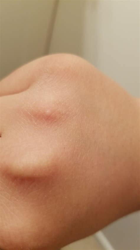Weird White Bump On Knuckle Normal More In Comments Rmedicaladvice