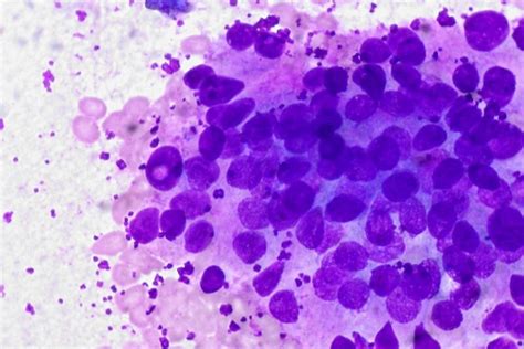 What Is The Difference Between Giemsa Stain And Wright Stain Pediaacom