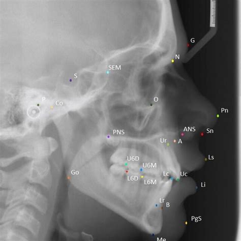 A Sample Cephalometric X Ray Showing The True Positions Of The 26