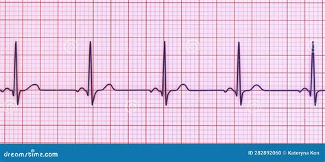 A Normal Electrocardiogram 3d Illustration Stock Illustration