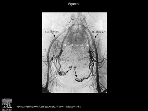 Uterine Artery Embolization For Symptomatic Uterine Myomas Ppt Download