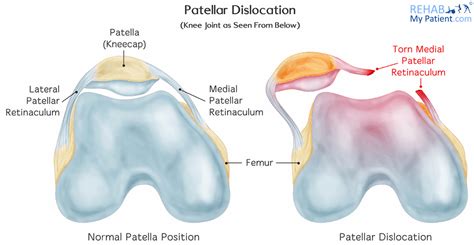 Patella Dislocation Manor View Practice Patella Dislocation Manor View Practice