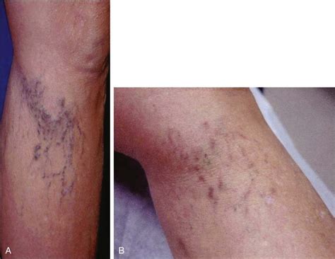 Varicose Veins Thoracic Key