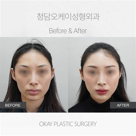 Fat Grafting In Korea Okay Plastic Surgery In Gangnam