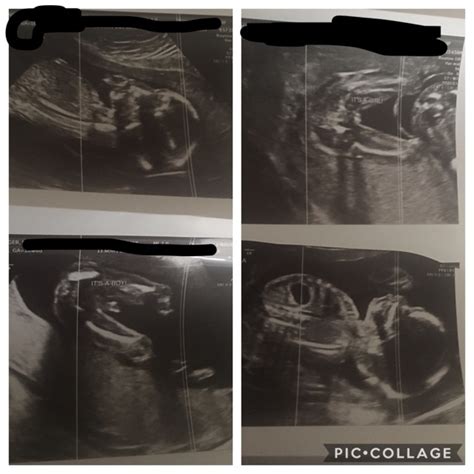 Anatomy Scan ️ The Twins Are Perfect Now I Actually Have Proof That I