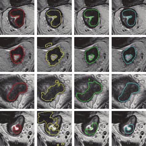 Rectal Tumors Segmentation In T2w Mri Images Rows 1 4 Were Different