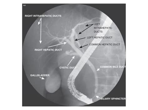 Endoscopic Retrograde Cholangiopancreatography Pptx Digestive