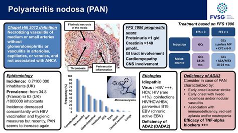 Diagnosis And Management Of Polyarteritis Nodosa Pan 56 Off