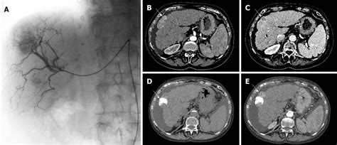 Idarubicin Vs Doxorubicin In Transarterial Chemoembolization Of