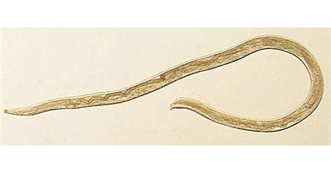 14 Tiny Worms Removed From Oregon Womans Eye In First Known Human Case