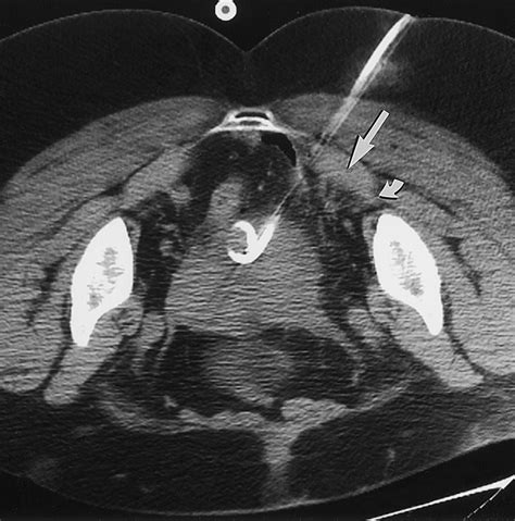 Ct Guided Transgluteal Drainage Of Deep Pelvic Abscesses Indications