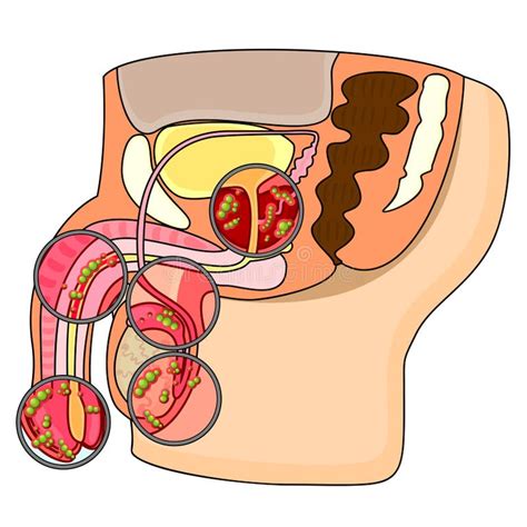 Diseases Male Reproductive System Stock Illustrations 20 Diseases
