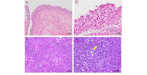 Histopathological Examination In The Bladder Ureter And Para Aortic