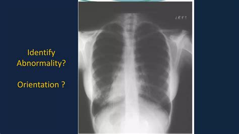 Pediatric Chest X Ray Interpretationpdf