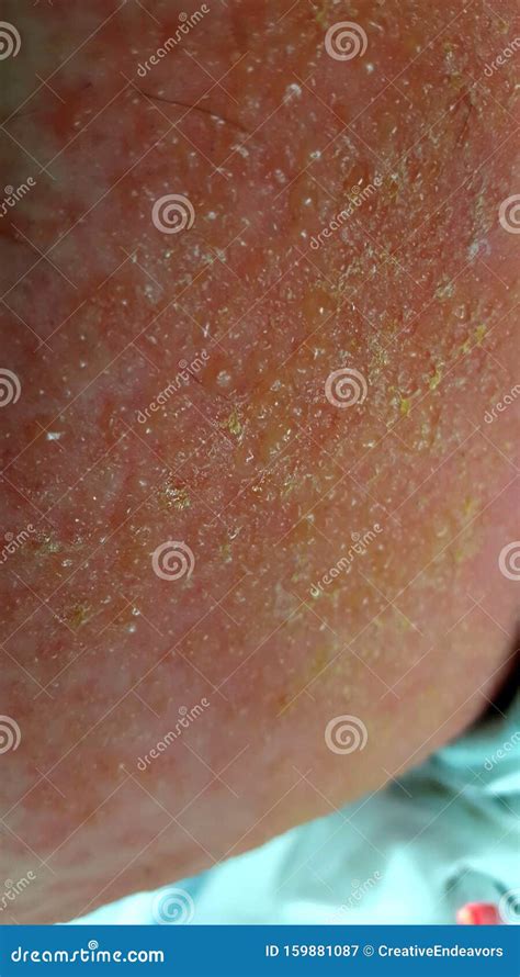 Strep Infection Cellulitis At Belinda Tetrault Blog