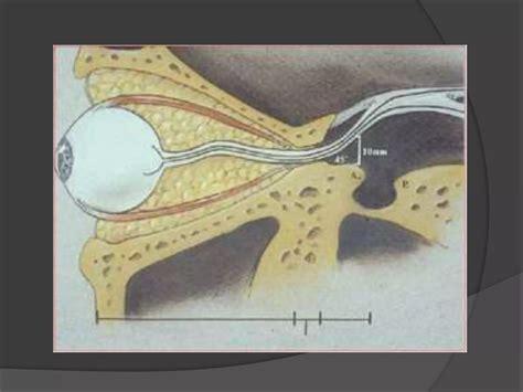 Traumatic Optic Neuropathy Pptx