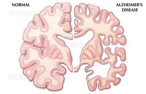 Photograph Alzheimers Disease Brain Comparison Science Source Images