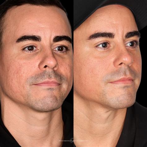 Wiqo Prx T33 Results Prx T33 Before And After Timewise Repair